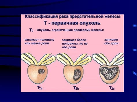 Рак предстательной железы презентация онлайн