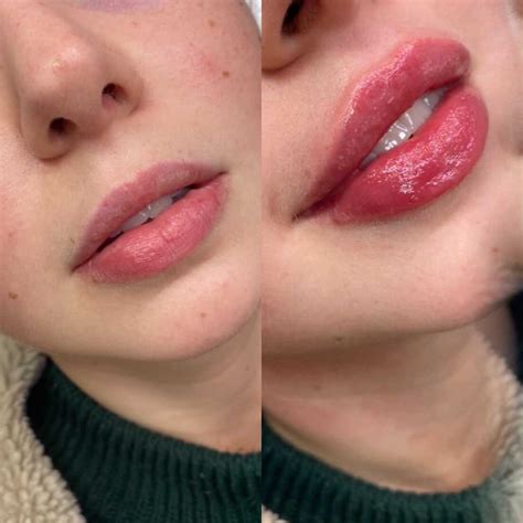 1ml Lip Fillers Lips Inspiration Lip Fillers Lip Fillers Juvederm