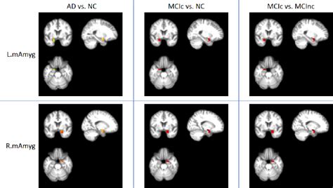 Figure 1 From Adaptive 3dcnn Based Interpretable Ensemble Model For Early Diagnosis Of Alzheimer