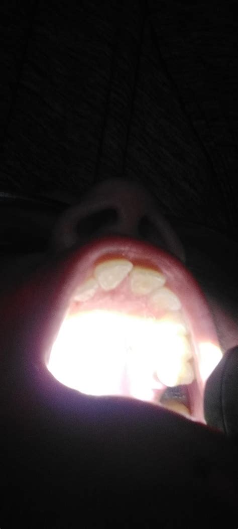 Do I Have Dry Socket R Askdentists