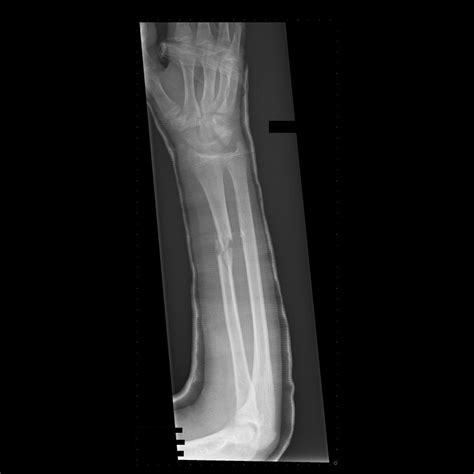 Forearm Fracture Cast Position At Shanita Parker Blog