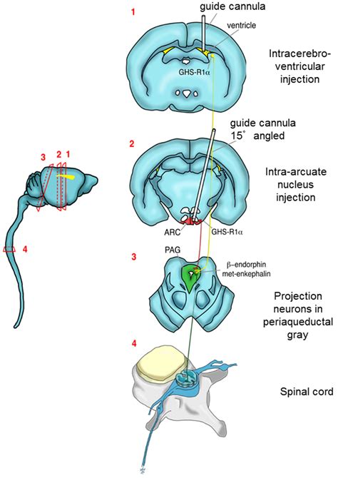 Intraventricular Injection