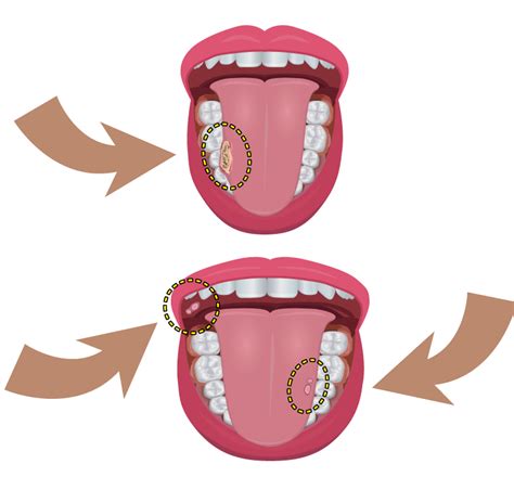 Calgary Dental Oral Cancer Screening Advance Your Health Dental Dr