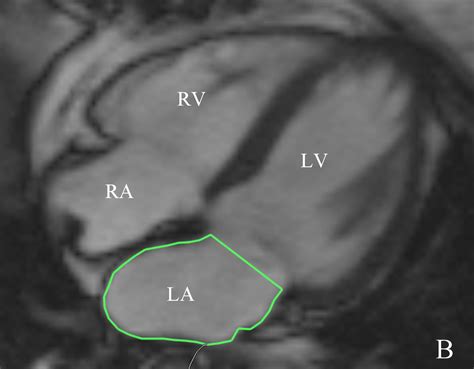 Figure 21 From Assessment Of Left Atrial Structure And Function In The