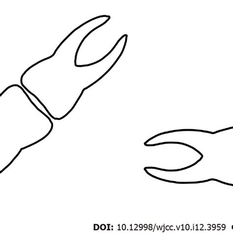 Classification Of Kissing Molars According To The Impaction Direction