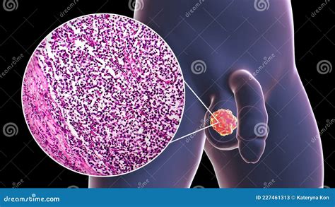 Testicular Cancer 3d Illustration And Light Micrograph Stock