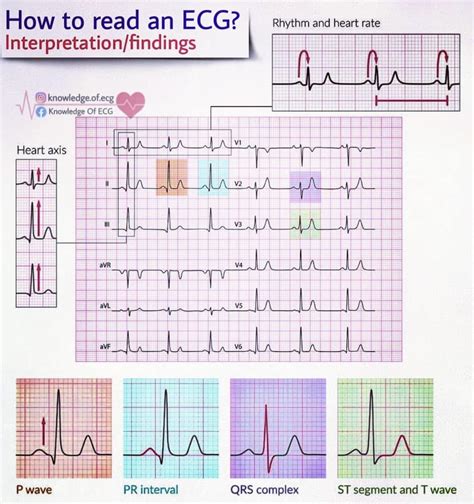 🧐how To Read An Ecg🧐 One Way Of Knowledge Of Ecg