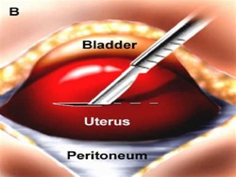Caesarean Sections Part One Robson Classification Of Caesarean Section