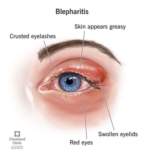 Blepharitis Eyelid Inflammation Causes Treatment Artofit
