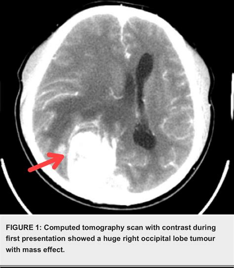 Figure 1 From Bilateral Inferior Altitudinal Visual Field Defect In