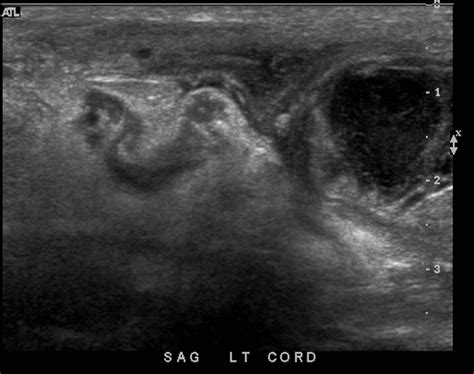 Spermatic Cord The Common Vein