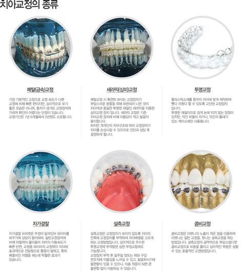 치아 부정교합의 종류