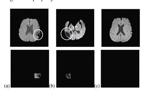 Figure 13 From Automated Segmentation Of Brain Lesion Based On Diffusion Weighted Mri Using A
