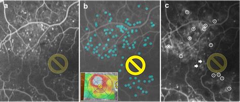 Assessment Of Microaneurysm Closure Rate Following Navigated Laser Download Scientific Diagram