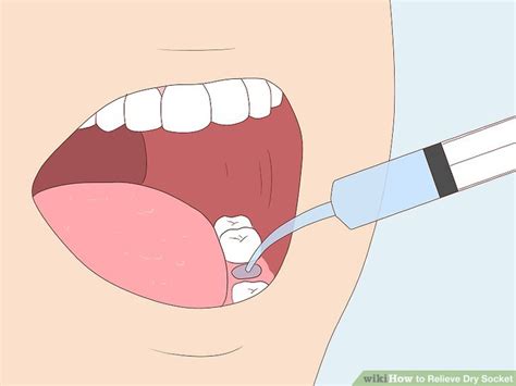 Ways To Relieve Dry Socket WikiHow