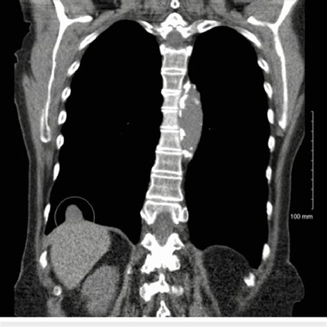 Low Dose Ct Scan Posteroanterior View Low Dose Ct Scan Pa View Showing