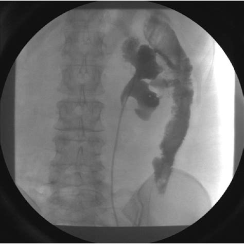 Retrograde Pyelogram Revealing A Stenotic Two Centimeter Proximal Download Scientific Diagram