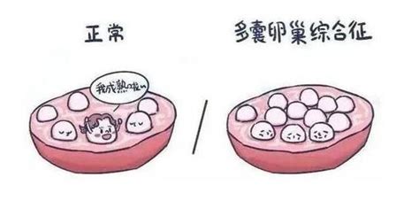 多囊卵巢综合征为什么会导致不孕 今日看点