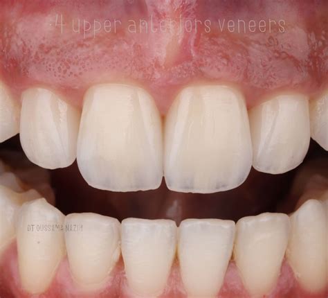 Oussama Nazih On Linkedin 4 Upper Emax Crowns