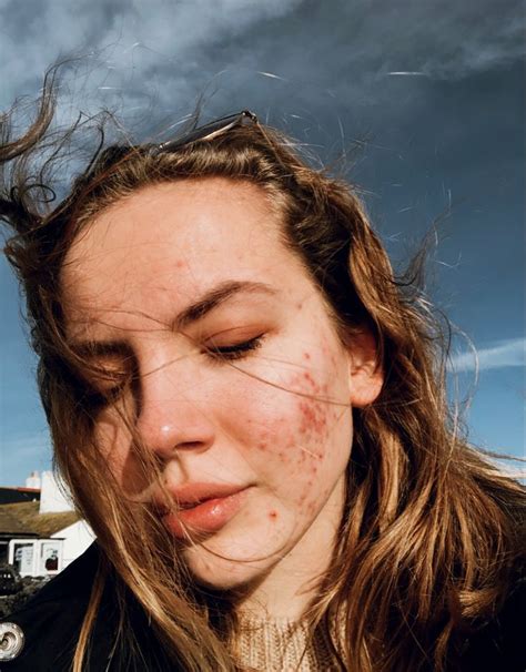 Girl With Acne Girl With Acne Acne Aesthetic Girl
