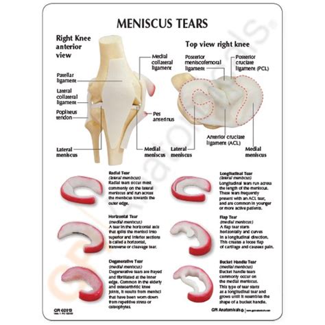 Knee Anatomy Model Meniscus Tears Clinical Charts And Supplies
