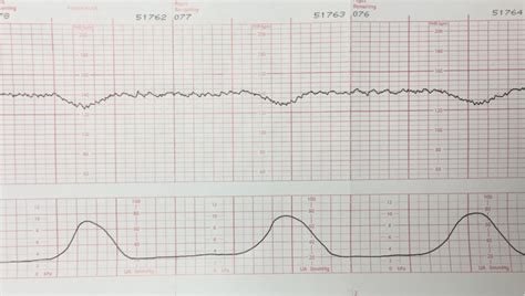 Early Decelerations Military Obstetrics And Gynecology 3rd Edition