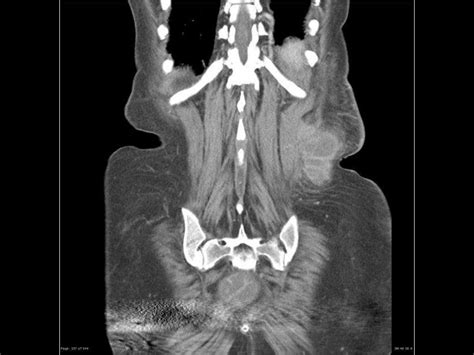 Perinephric Abscess Imaging