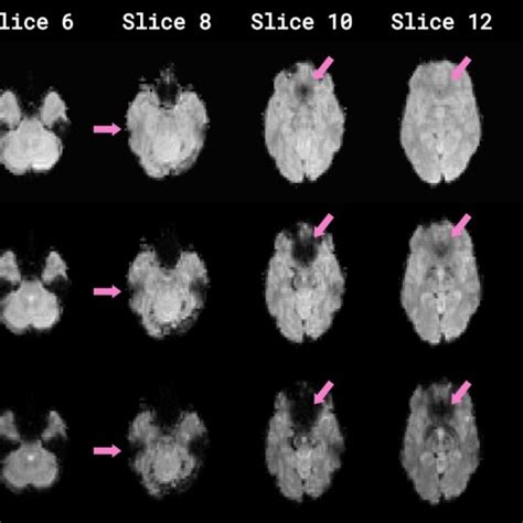 Pdf The Effects Of Multi Echo Fmri Combination And Rapid T 2