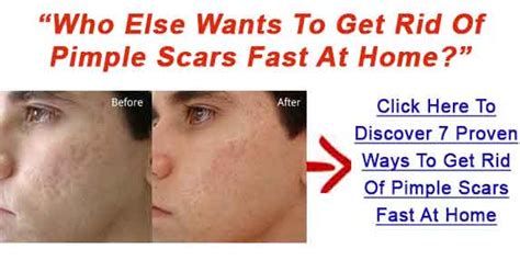 How To Get Rid Of Pimple Scars Fast Heal Acne Marks Easily How To Get Rid Of Pimple Scars Fast Heal Acne Marks Easily