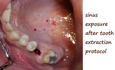 Sinus Exposure After Tooth Extraction Protocol Dr Haroon Dental Specialist Clinic Hayatabad