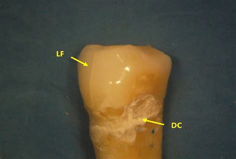 The Premolar Crown In The Middle Of The Buccal Aspect There Is A