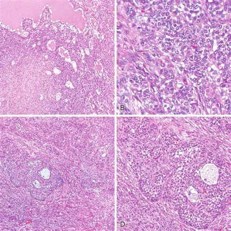 Photomicrography Of The Testis Tumor Hande A Panoramic View