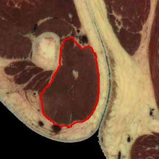 Random Walker Segmentation Of The Right Biceps Of A High Resolution