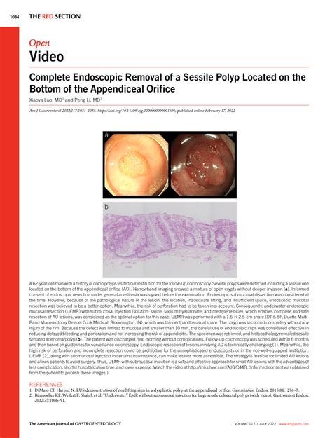 Pdf Complete Endoscopic Removal Of A Sessile Polyp Located On The Bottom Of The Appendiceal