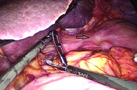 The Laparoscopic View Showed The Gastric Serosal Surface Of Lesion Was