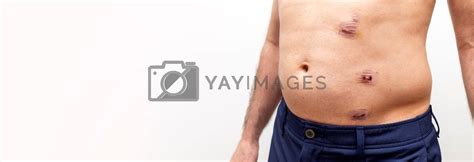 Banner Laparoscopic Appendectomy Surgery Three Scars In Abdomen Area Copy Space Horizontal