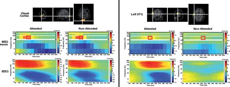 Figure 1 From Simultaneous Meg Intracranial Eeg New Insights Into The