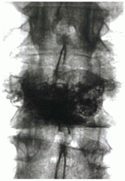 Pip Joint Dislocations Teachme Orthopedics