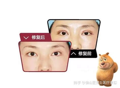 双眼皮手术的5个常见问题解析 知乎