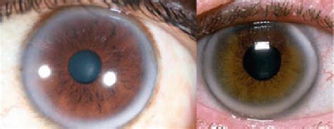 Iris Image Of High Level Cholesterol Patient Download Scientific Diagram