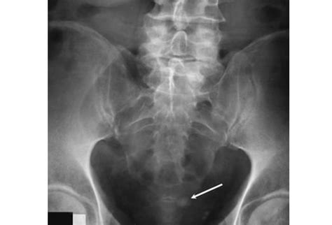 Critical Findings On Plain Abdominal Radiographs Slideshow