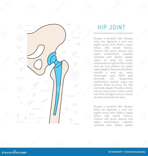 Medical Illustration Hip Joint Stock Vector Illustration Of Arthritis