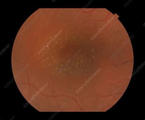 Crystalline Maculopathy Stock Image C0307012 Science Photo Library