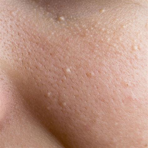 What S On My Skin 8 Common Bumps Lumps And Growths Sk