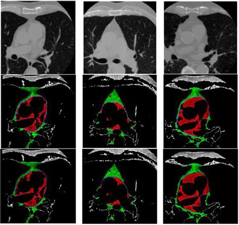 Comparison Of Three Slices For The Automatic Segmentation Approach And
