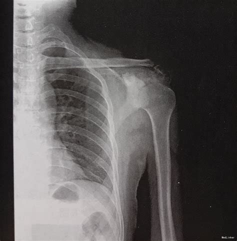 右肩胛骨尤文肉瘤 医联