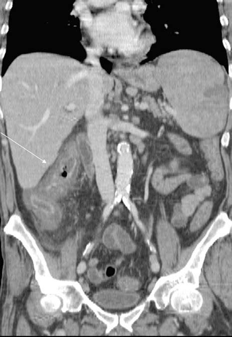 Typhlitis In A Post Chemotherapy Lymphoma Patient Images In Clinical