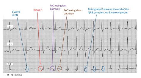 Avnrt Ecg Guru Instructor Resources