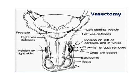 Tubectomy Non Scalpel Vasectomy Sterilization Ppt