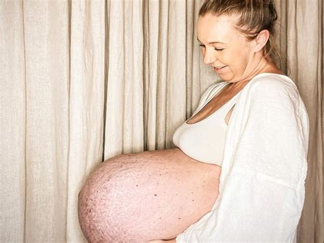 Bosse Ventre Grossesse Diastasis Avec Relâchement Du Ventre Quel